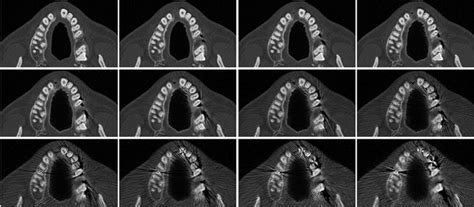 metal induced streak artifact reduction using iterative reconstruction algorithms in x ray