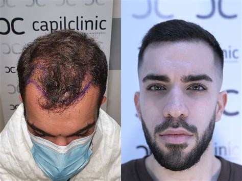 Capilclinic Madrid Clínica Opiniones Foro Tener Pelo