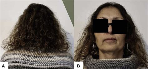 Minoxidil Before And After Photos Results Wimpole Clinic