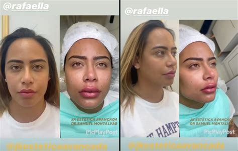 Rafaella Irma Neymar Antes E Depois On Sale Dakora Co
