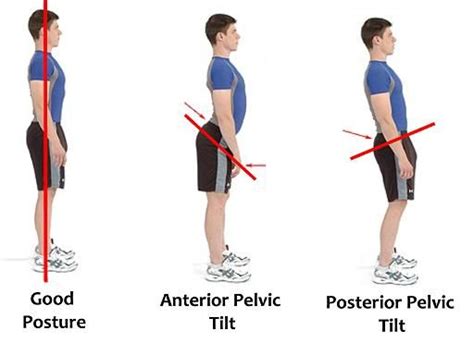Posterior Pelvic Tilt Cause Symptom Treatment Physiotherapy Exercise