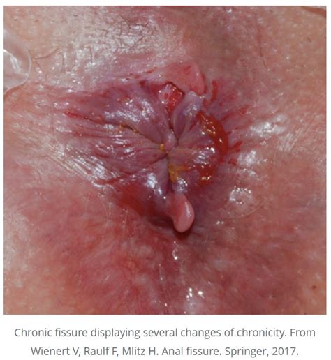 Chronic Anal Fissure Displaying Several Changes Of Grepmed Daftsex Hd
