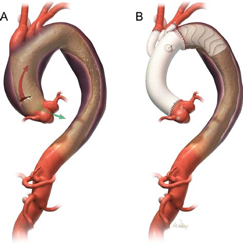 Contemporary Surgical Strategies For Acute Type A Aortic Dissection