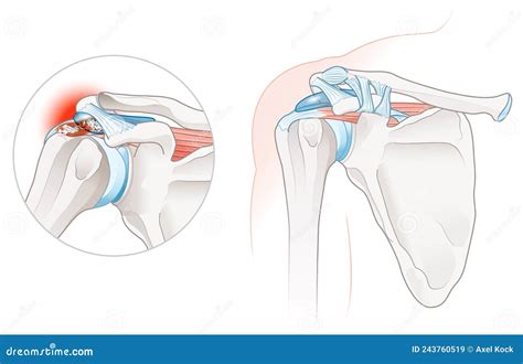 Calcific Tendinitis Shoulder Illustration Labeled Stock Illustration