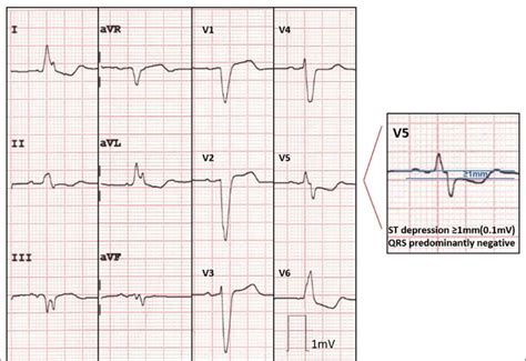 ECG From A Patient With Acute Myocardial Infarction And Culprit Lesion