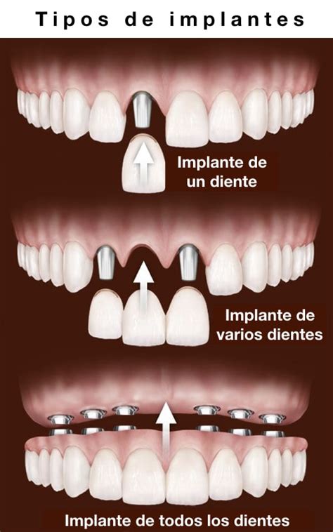 Cómo es el proceso de colocación de Implantes dentales Vital