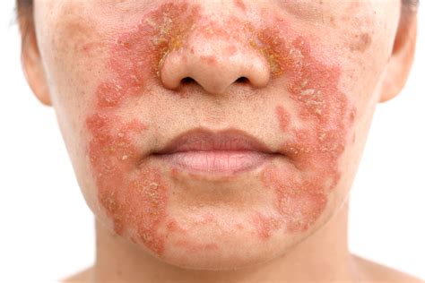 Atopowe Zapalenie Sk Ry Interdyscyplinarne Rekomendacje Diagnostyczno