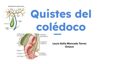 Quistes Del Coledoco Laura Sof A Moncada Udocz