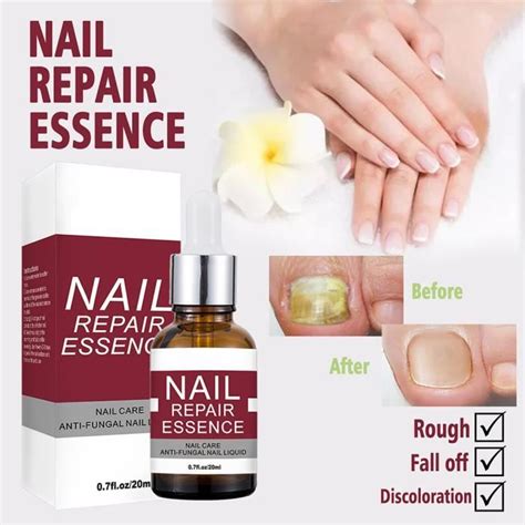 Pwshymi S Rum Pour Les Ongles Mycos S Soin Des Ongles Victimes De La