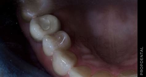 Qué es un empaste dental Todo sobre empastes dentales