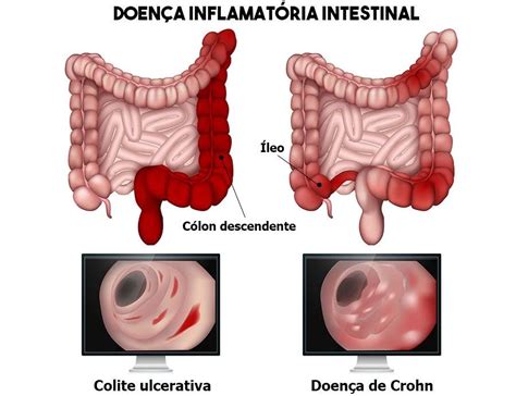 Saiba como diferenciar a doença de Crohn da colite ulcerativa