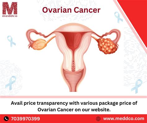 All You Need To Need To Know About Ovarian Cancer Part 2