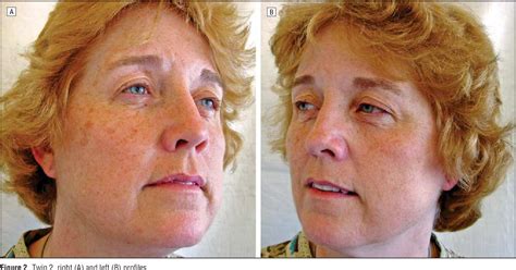 PDF Smoking And Skin Aging In Identical Twins Semantic Scholar