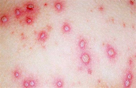 Clinical Practice Guidelines Chickenpox Varicella