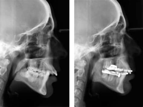 Distractions Chirurgie Des M Choires Paris Cas Avant Apr S