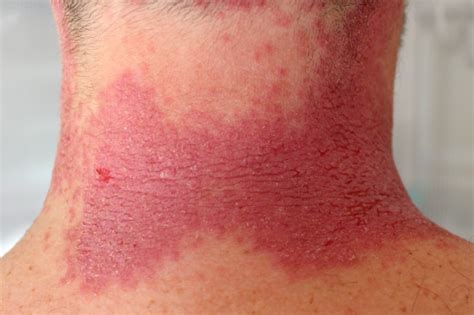 Dermatita Herpetiforma Ce Este Si Cum Se Trateaza