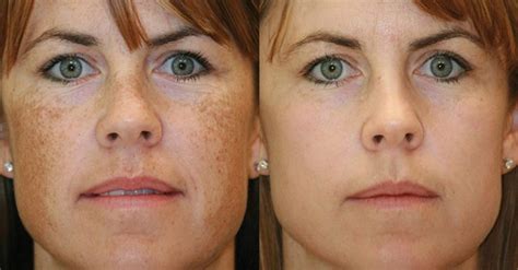 Voici comment éliminer les taches brunes de votre visage en quelques
