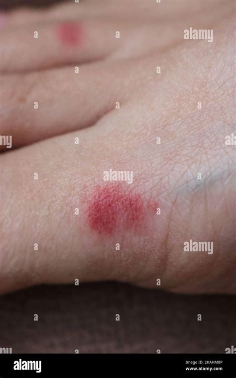 Inflammation rouge causée par des lésions cutanées après une piqûre d