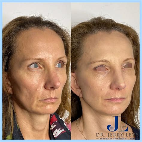 Lifting cervico facial à Paris Dr Jerry Levy