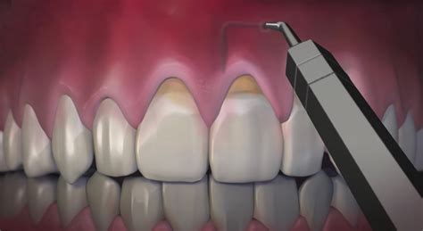 Pinhole Surgical Technique Pst Arkansas Periodontal And Implant