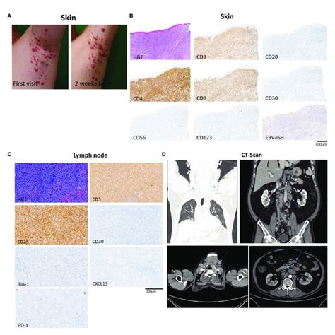 Overview Of A Patient With Adult T Cell Leukemia Lymphoma Involving