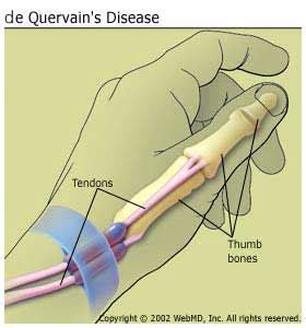 De Quervain Disease Causes Symptoms Treatment