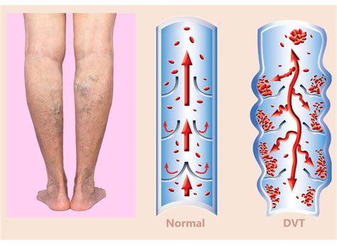 Trombose Causas Sintomas E Tratamentos Brazil Health LSA