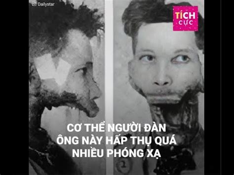 Đây là một trong những người nhiễm p h ó n g x ạ nặng nhất thế giới