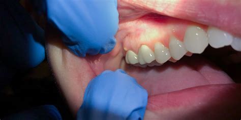 Tengo un flemón dental Qué puedo hacer Dental Cerro Alonso
