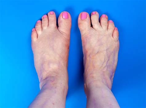 Pes Anserine Bursitis Symptoms Test And Treatments