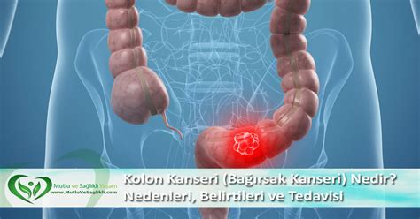 Kolon Kanseri Ba Rsak Kanseri Nedir Nedenleri Belirti Flickr