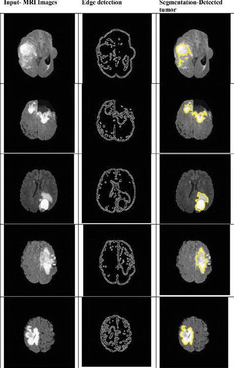table 1 from comparison of brain tumor detection in mri images using straightforward image