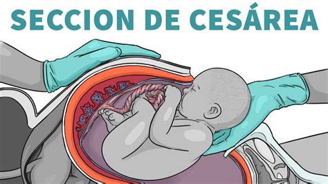Parto por Cesárea 13 Preguntas Frequentes Sobre la Cesárea Stanford