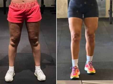 Kéfera Buchmann impressiona antes e depois de pernas após