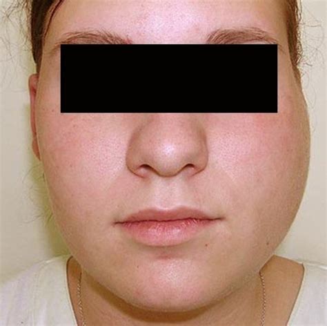 Parotitis Symptoms Causes Treatment And Pictures HubPages