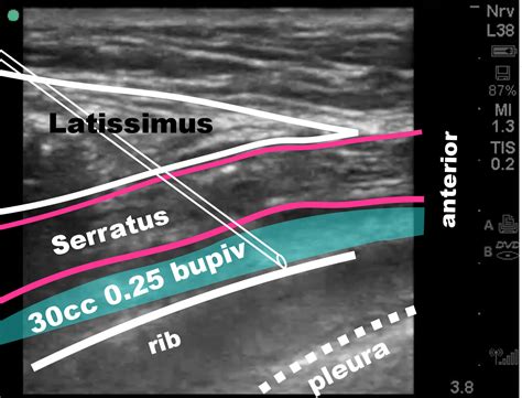 PECS SERRATUS Highland EM Ultrasound Fueled Pain Management