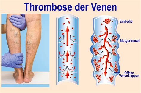 Thrombose Praxis Klinik Dr Med Nidal Assaf Ambulantes Operationszentrum
