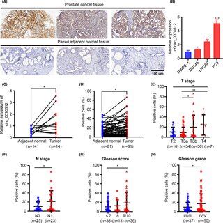 Knockdown Of Hsa Circ 0070512 Inhibits The Proliferation And Migration