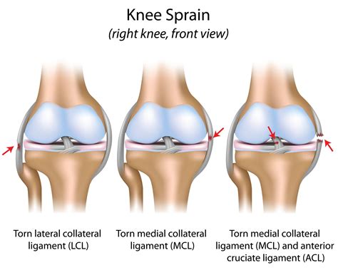 Two Boneheads Video Series The MCL Sprain Town Center Orthopaedics