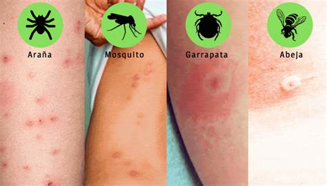 las picaduras de garrapatas Consecuencias síntomas tratamiento