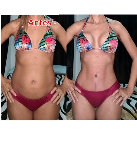 Lipoescultura Abdominoplastia E Mastopexia Proteses De Silicone De