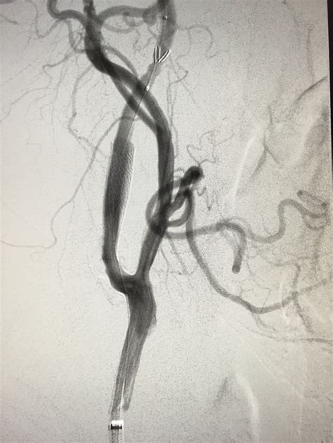 Carotid Angiogram Stent Hamilton Cardiology Associates New Jersey S