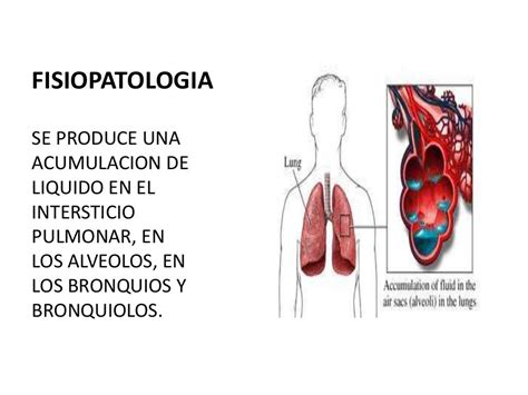 Edema Pulmonar Agudo