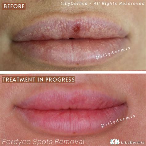 Fordyce Spot Removal LiLyDermis Calgary