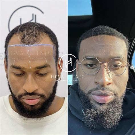 Greffe De Cheveux Afro En Turquie Proc Dure Et Co T En Heva