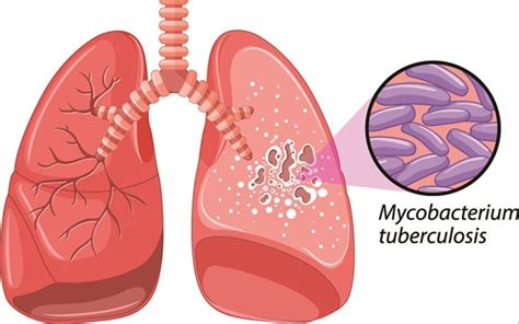 Bệnh lao phổi Nguyên nhân triệu chứng và cách điều trị An Tâm