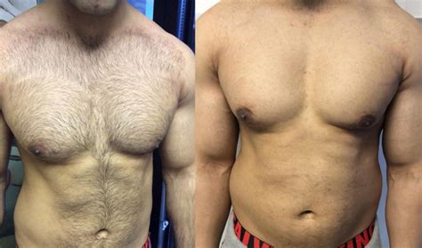 Depilação Íntima Masculina Métodos e Como fazer