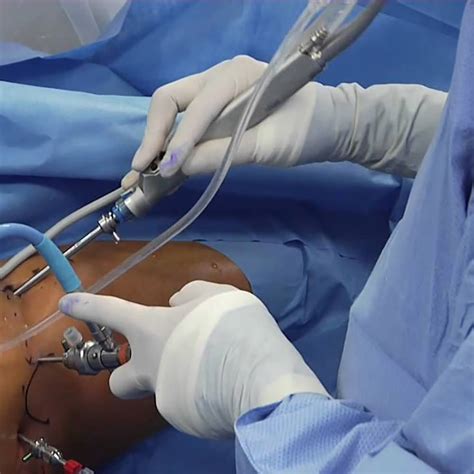 Patient Information Precision Orthopaedic Specialties
