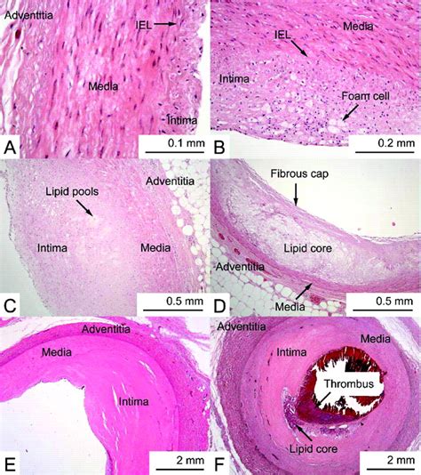 Artery Related Differences In Atherosclerosis Expression Stroke
