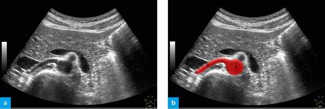 Proximal Renal Artery Ultrasound